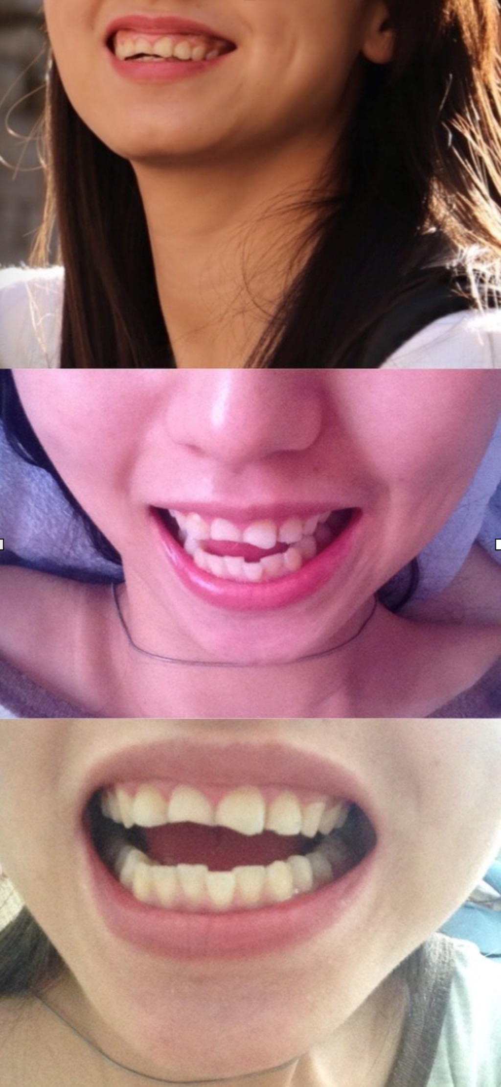 我这样的牙齿还有的救吗？ - 贝致——专业口腔服务平台，让你变美的牙套交流社区